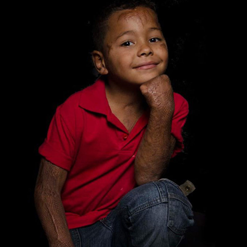 Pediatric Burn Survivor Support | Beyond the Burn Foundation